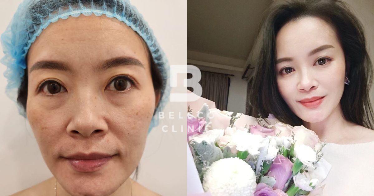 PROFHILO Skin Collagen Booster | Beleco Clinic MY